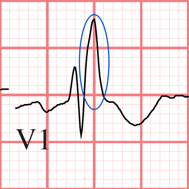 Teaching Medicine - Tutorial: Bundle Branch Blocks